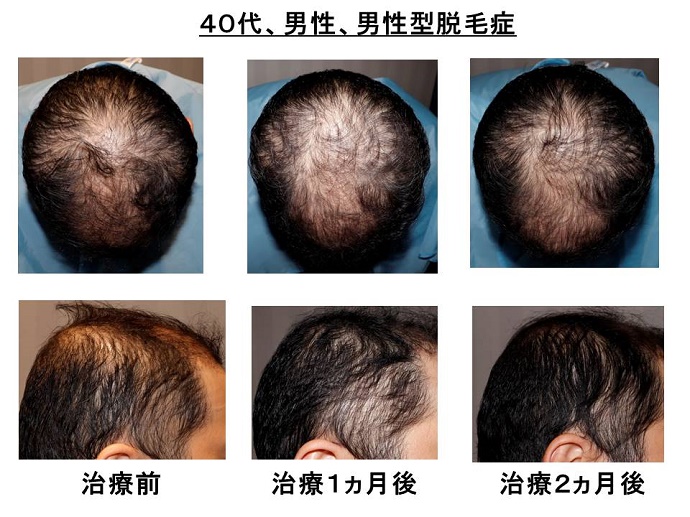 10年間悩んでいた、男性型脱毛症が、毛の生え変わりを経て、2ヵ月で改善！ 患者様からの声・メディア掲載・クリニックからのお知らせ 名古屋